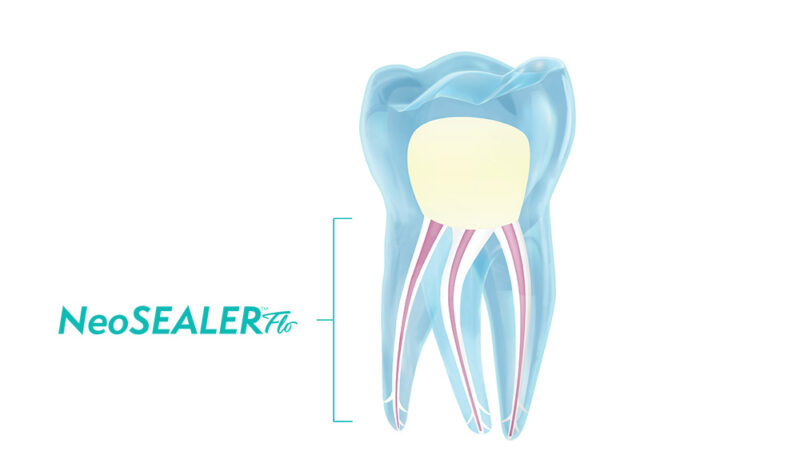 NeoSEALER® Flo - Avalon Biomed